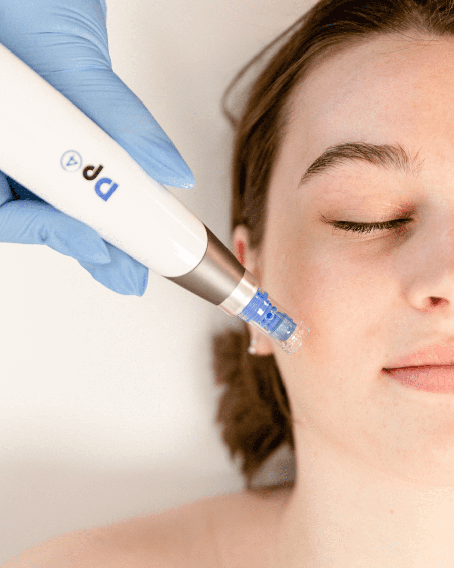 Microneedling DP4 | Cliniques Viva