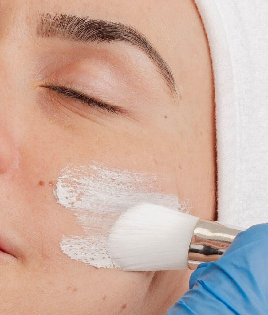 Peeling | Cliniques Viva