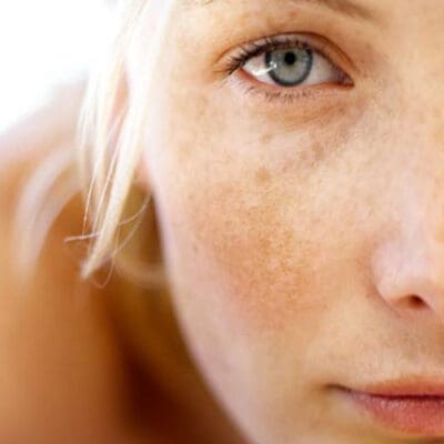 Taches pigmentaires | Cliniques Viva