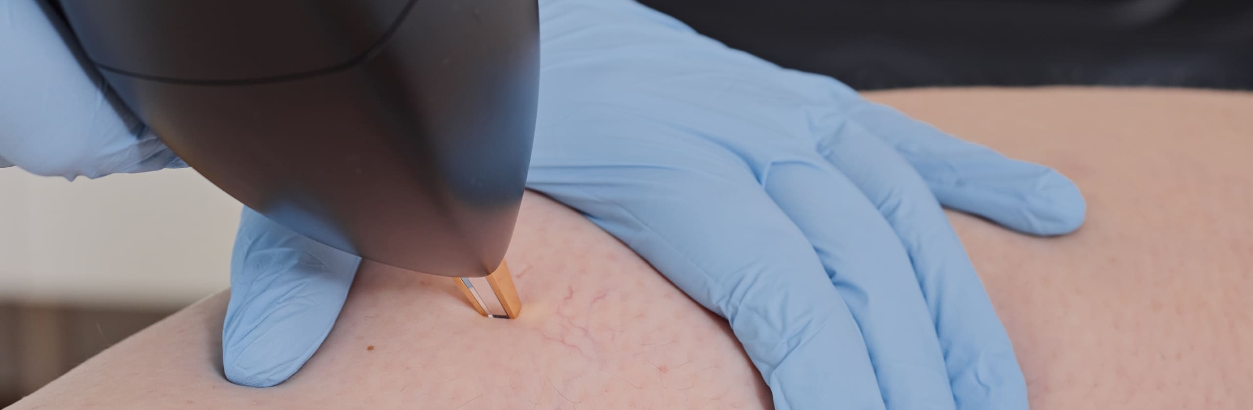 Laser vasculaire : enlevez varicosités et points de rubis